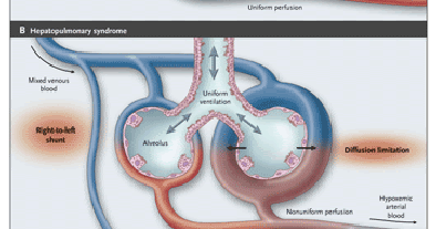 Medicine Decoded: Platypnea-orthodeoxia